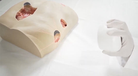 Silhouette Demonstration Videos - ARANZ Medical